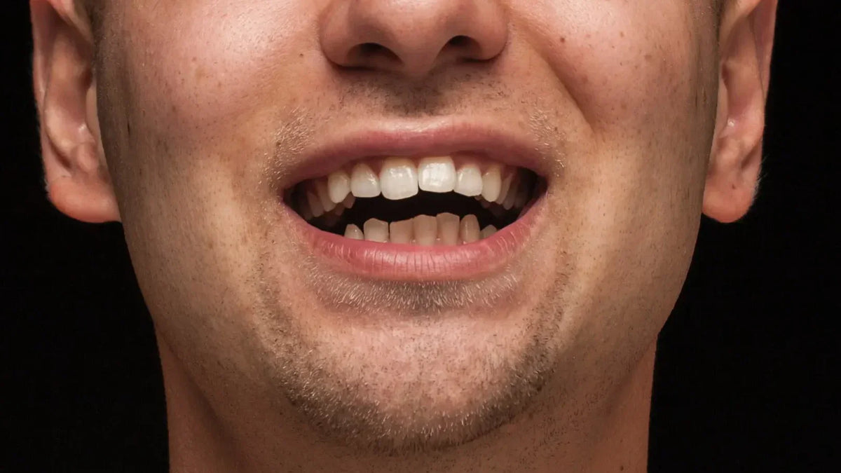 BROWN STAINS ON TEETH: WHAT CAUSES THEM? – Smyle